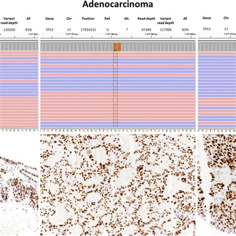 Illustration Of The Tp53 Gene Alteration And P53 Immunohistochemical