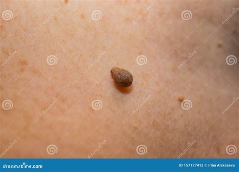 Pedunculated Skin Tag Or Acrochondon Or Soft Fibroma Papilloma On