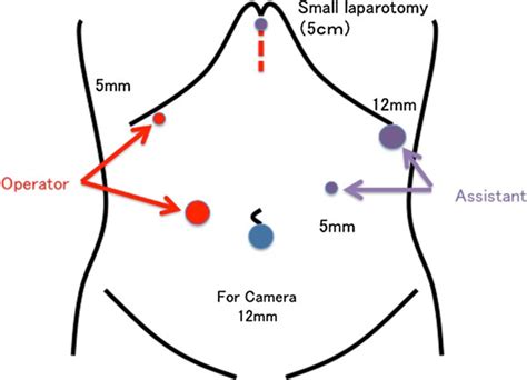 The Port Positions Used In Our Standard Approach For Laparoscopic
