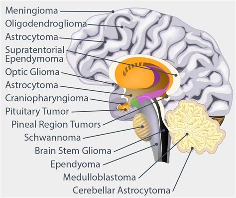 Types Of Brain Tumors And Effective Treatment
