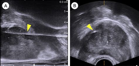 Recent Advances And Current Role Of Transperineal Prostate Biopsy