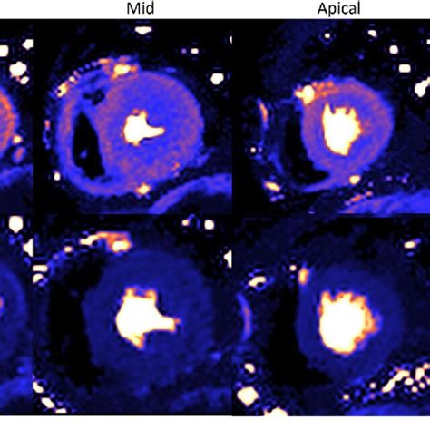 Example Of Abnormal Perfusion Scanning Results On Cardiac Mri The