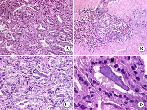 A B Histological Findings Of The Sternum Tumor Biopsy Revealed A