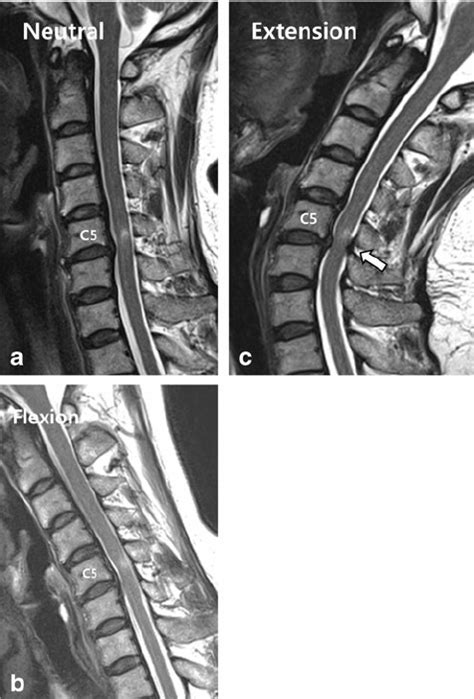 Cervical Compressive Myelopathy Was Verified Using Extension Magnetic