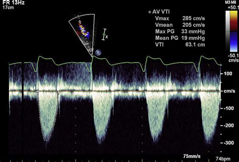 Continuous Wave Doppler Profile Of The Aortic Valve Download