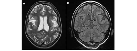 T2 Weighted Axial Magnetic Resonance Image A And Fluid Attenuated