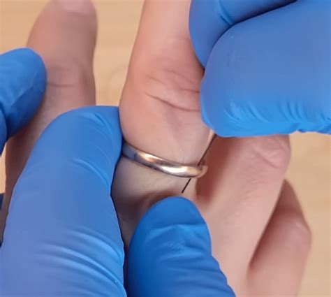 How To Remove Stuck Ring On Finger