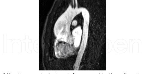 Figure 1 From Novel Phenotypes In Bicuspid Aortic Valve Disease