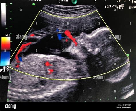 Fetal Ultrasound Of A Fetus Its Head Is In Profile And It Expels
