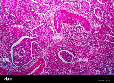 Cervical Cancer Light Micrograph Lm Of A Section Through A Squamous