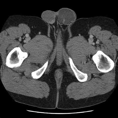 Cystadenoma Of The Rete Testis Sonographic Appearance Ajr