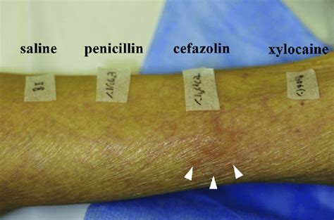 Results Of Intradermal Testing Intradermal Testing Showed A Strong
