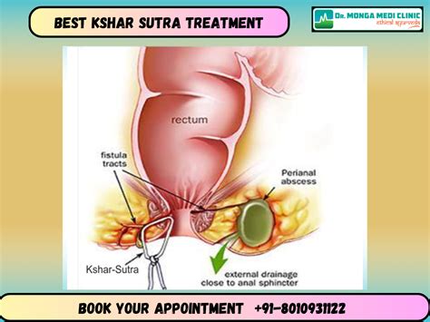 Best Kshar Sutra Treatment For Fistula Call 8010931122 Dr Monga