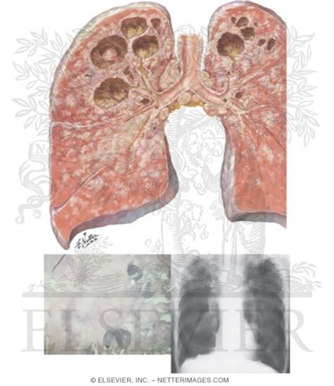 Pulmonary Tuberculosis Extensive Cavitary Disease