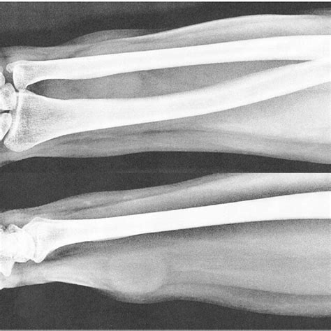Anteroposterior And Lateral Forearm Radiographs Download Scientific
