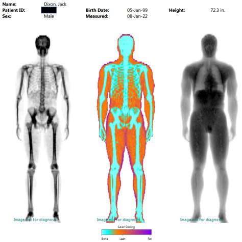 Dexa Scans My Results And Three Elements Essential To Longevity