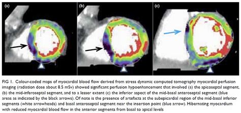 Dynamic Dual Source Computed Tomography Imaging For Myocardial