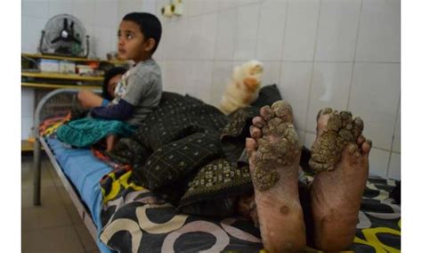 After 24 Surgeries Bangladesh Tree Man Relapses