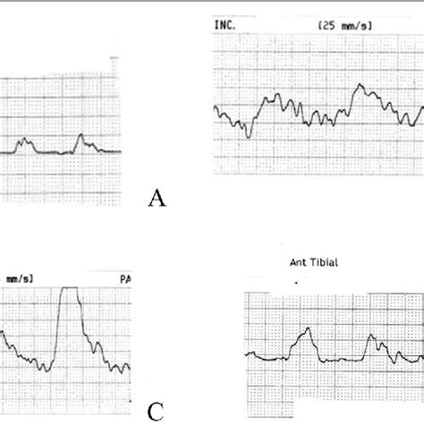 Examples Of Monophasic Waveforms Including Decreased Amplitude A