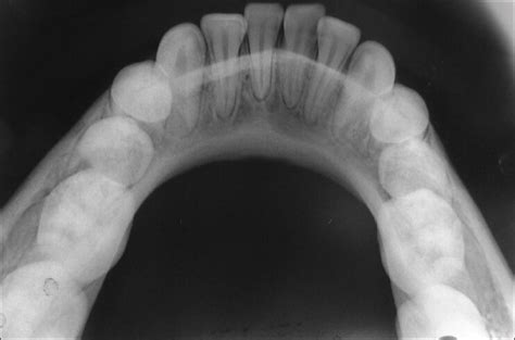 Anterior Occlusal Radiograph Of Mandibular Arch Showing Presence Of A