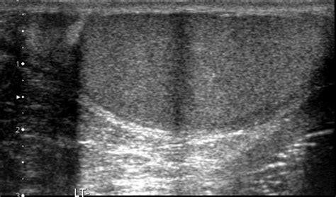 Testicular Anatomy Ultrasound