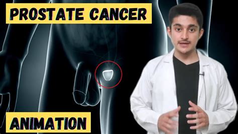 Prostate Cancer 3d Animation Causes Diagnosis Diagram Signs Digital
