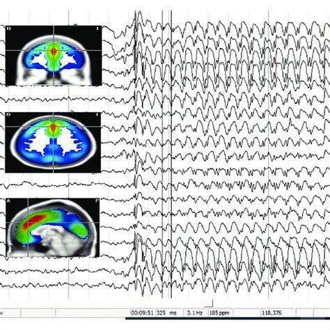 Eeg With Generalized Spike Wave Discharge At 3 1 Hz In Patient With