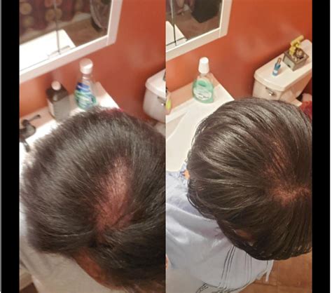 Irestore Laser Hair Growth System Fda Cleared Hair Loss Treatment