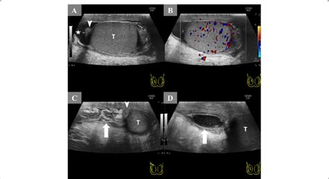 A Right Scrotum In Longitudinal View The Testis Has A Homogeneous
