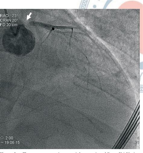 Figure 1 From Acute Myocardial Infarction Involving Left Main Artery In