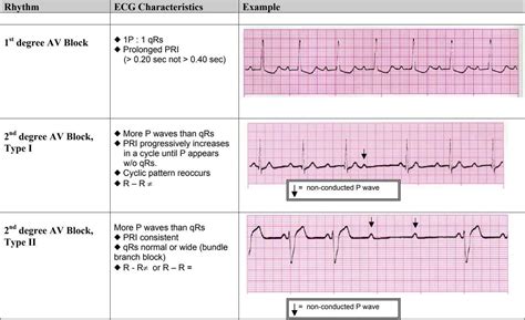 ekg examples electrocardiography cardiovascular system ekg