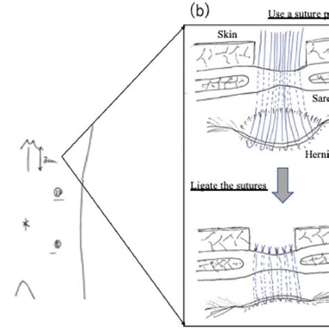 A Laparoscopic Port Site Position B Schematic Diagram Of Surgery