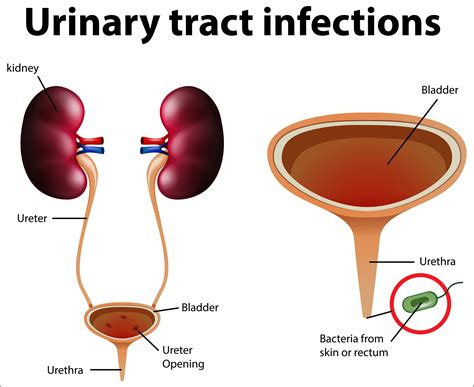 Urinary Tract Infection Causes Symptoms And Treatment