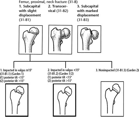 Femoral Neck Fracture Classification