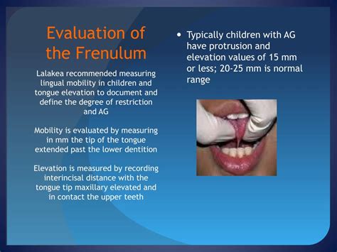 Ppt Ankyloglossia Powerpoint Presentation Free Download Id 2078965