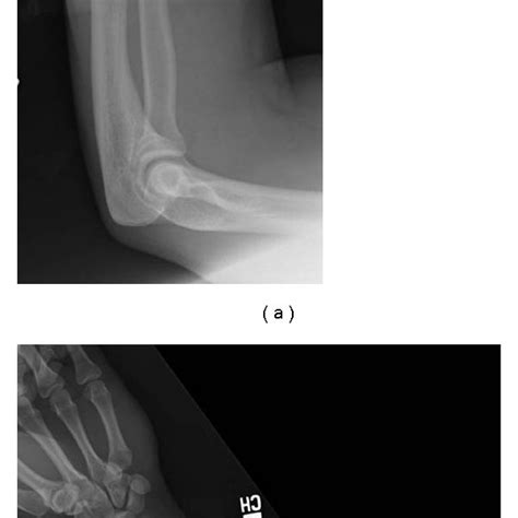 Preoperative A Anteroposterior And B Lateral Forearm Radiographs Of