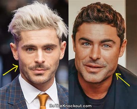 Zac Efron Plastic Surgery Comparison Photos