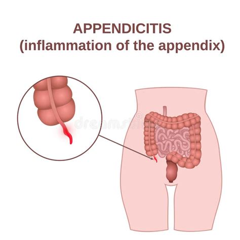 Inflammation Of The Appendix Stock Vector Illustration Of Abdominal