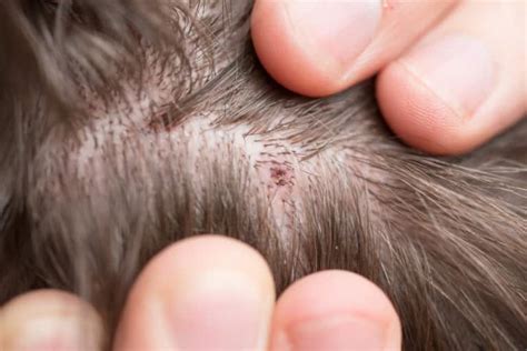 Scabs And Sores On Scalp 17 Causes Pictures And Treatment