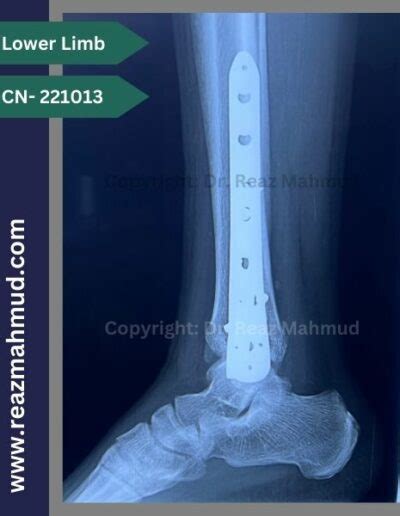 Bimalleolar Fracture Orif [221013] Dr Reaz Mahmud