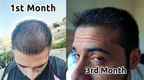 3 Months Result And Progress Of My Hair Transplant Hair Transplant