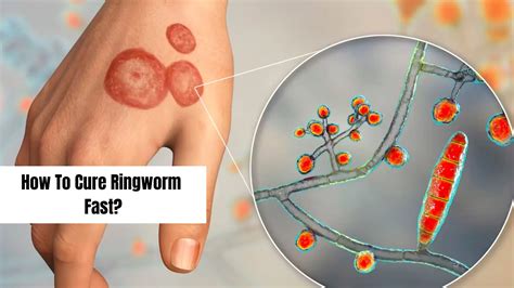 How To Cure Ringworm Fast Pure Visory