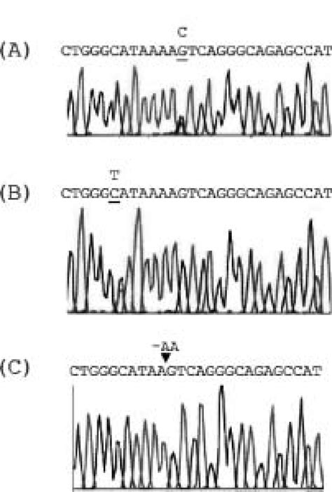 Three β Globin Gene Promoter Mutations Detected By Nt Sequencing