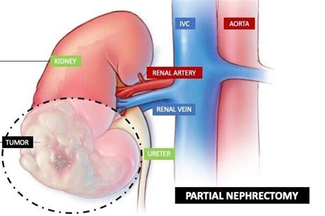 Robotic Partial Nephrectomy — Robotic Urology Santa Barbara Dr Pierre