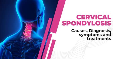 Cervical Spondylosis Causes Diagnosis Symptoms And Treatments