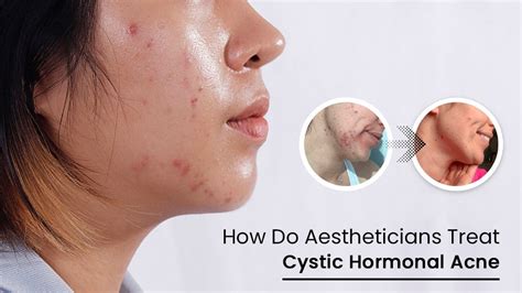 Adult Hormonal Acne