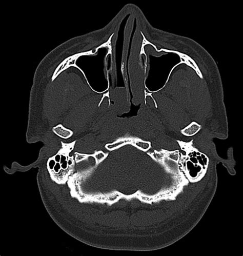 Computed Tomography Of The Sinuses Shows A Soft Density Mass Located In