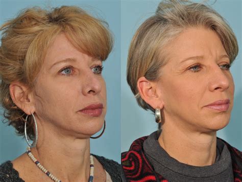 Facelift Before And After 21 Jesse E Smith Md Facs Ft Worth