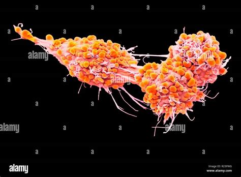 Ovarian Cancer Cells Coloured Scanning Electron Micrograph Sem Of