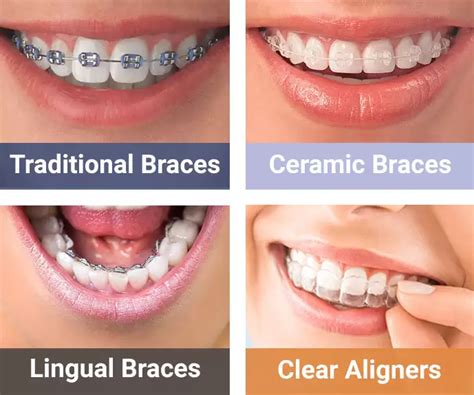 Invisalign Vs Ceramic Braces